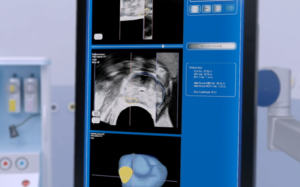 What Is High Intensity Focused Ultrasound (HIFU)? | Focal One