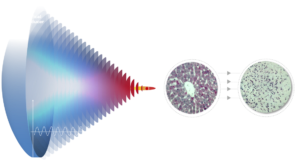 Focal Therapy in Prostate Cancer Management | Focal One