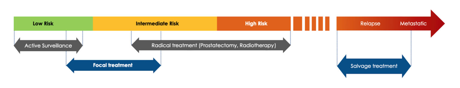 Focal Therapy in Prostate Cancer Management | Focal One
