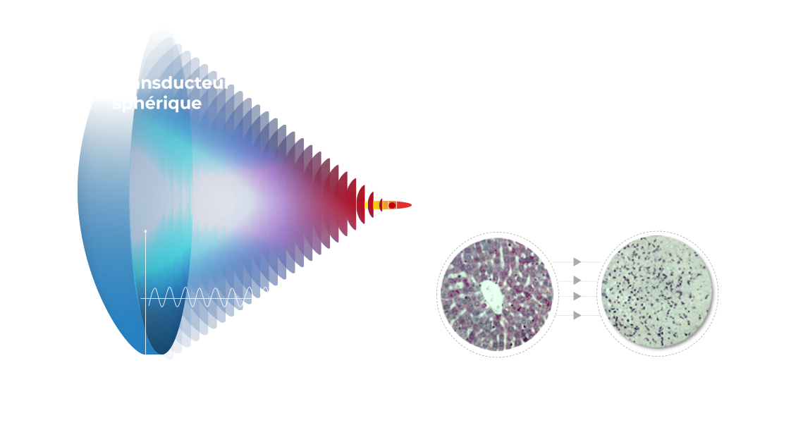 Prise en charge du cancer de la prostate | Focal One
